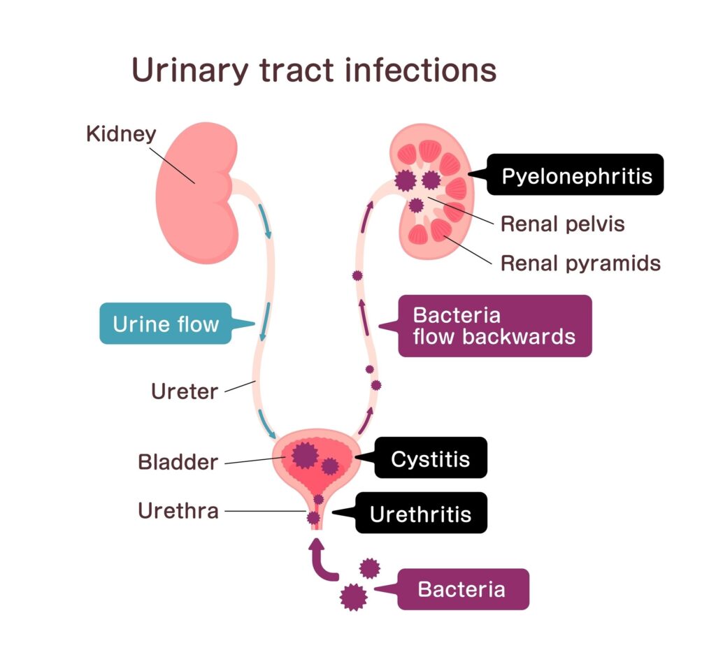 Urinary Tract Infection (UTI) Treatment in DC - Capital Women's Care DC